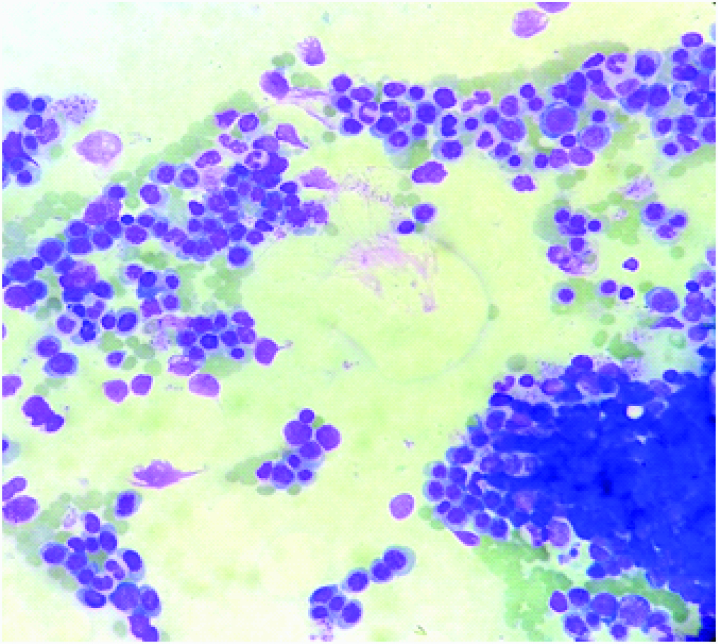 BMB sections of megaloblastic marrow (H & E, 10x)