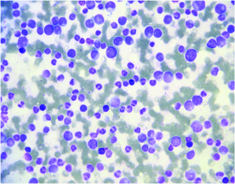 BMB sections of CML with mild degree of MF (H & E, 10x)