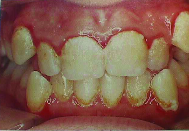 Clinical Features