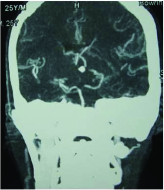CT angiogram revealed filling defect at the origin of right PCA (P1 ...