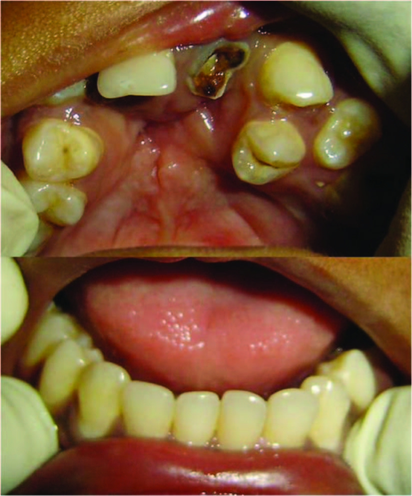 An orthopantamograph showing bilateral palatal cleft and missing ...