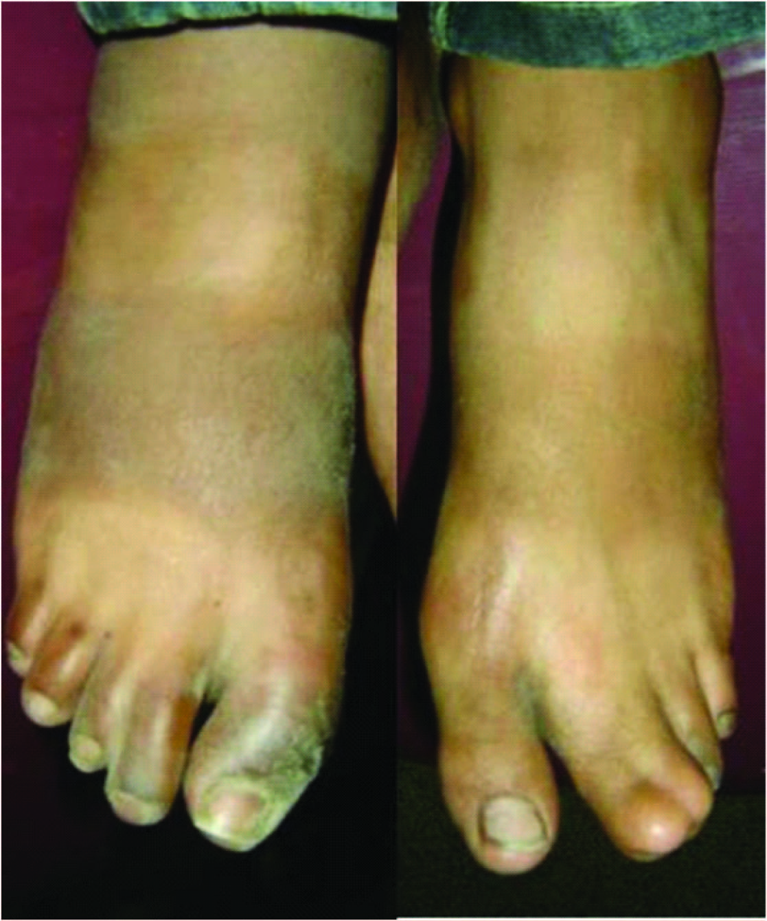 Absence of popliteal webbing and the scrotum and testicles