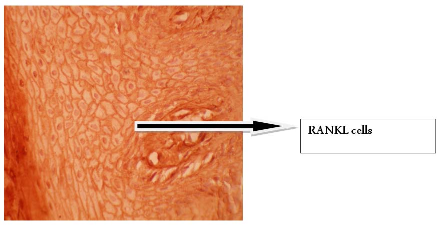 Shows RANKL positive cells in healthy tissue. (40X microscopic Image)
