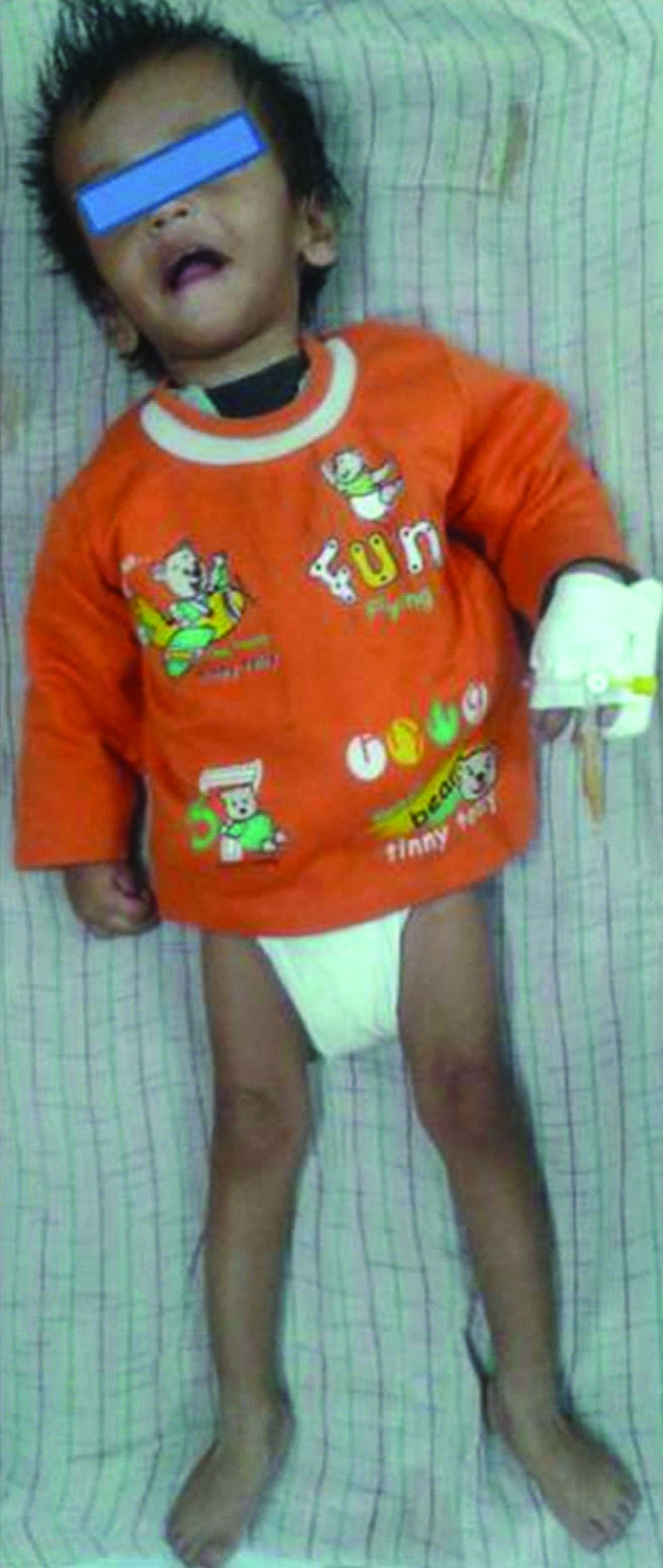 16 months old boy with AD: note the spasticity and contracture at ankle ...