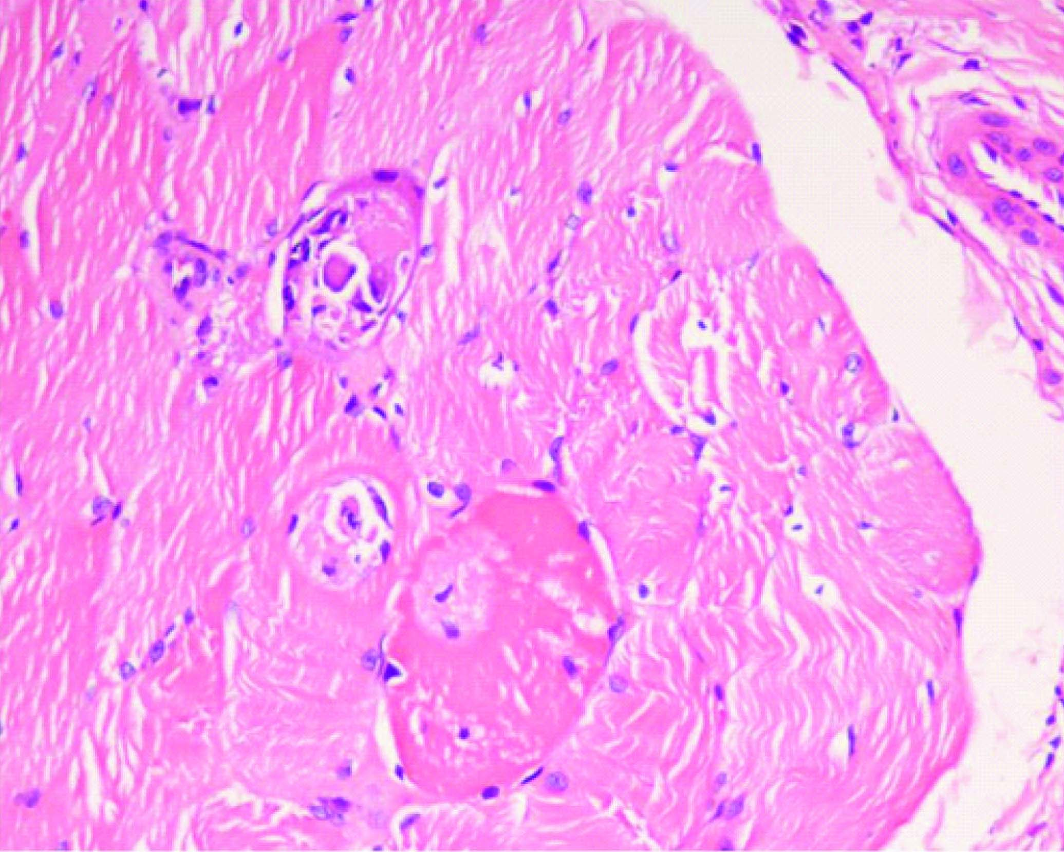 High power microscopy images show myophagocytosis with interfascicular ...