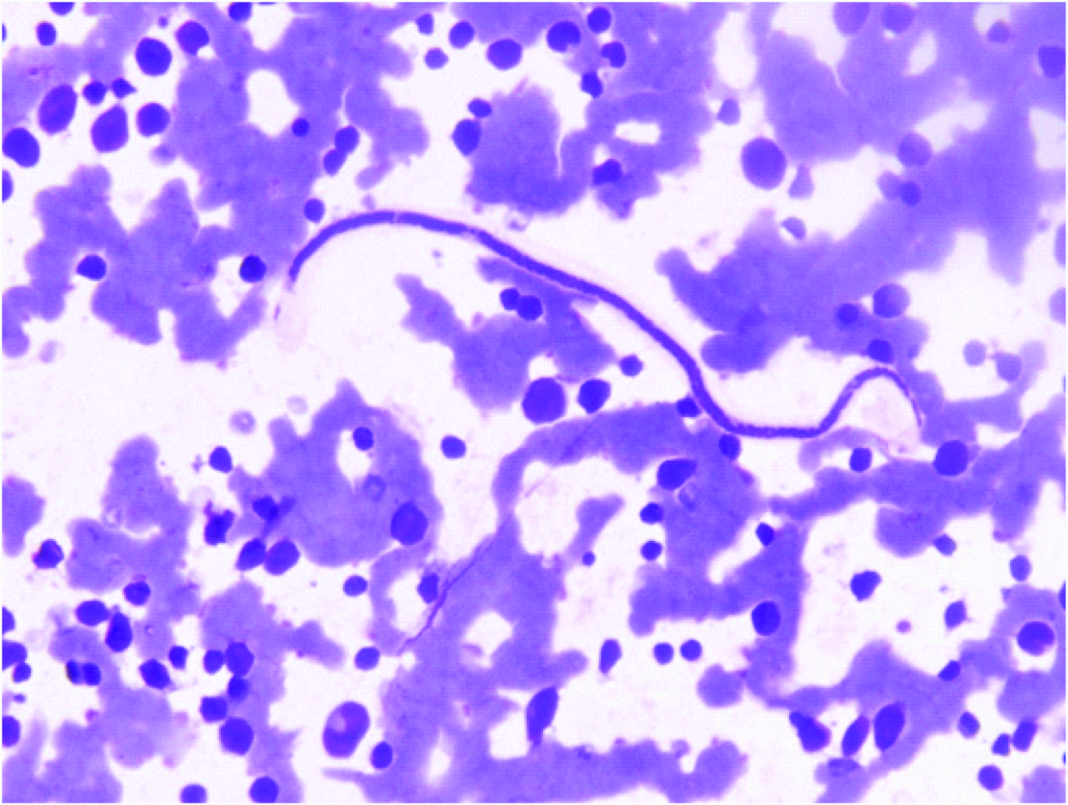 Bone marrow aspirate showing sheathed microfilaria with tip free from ...