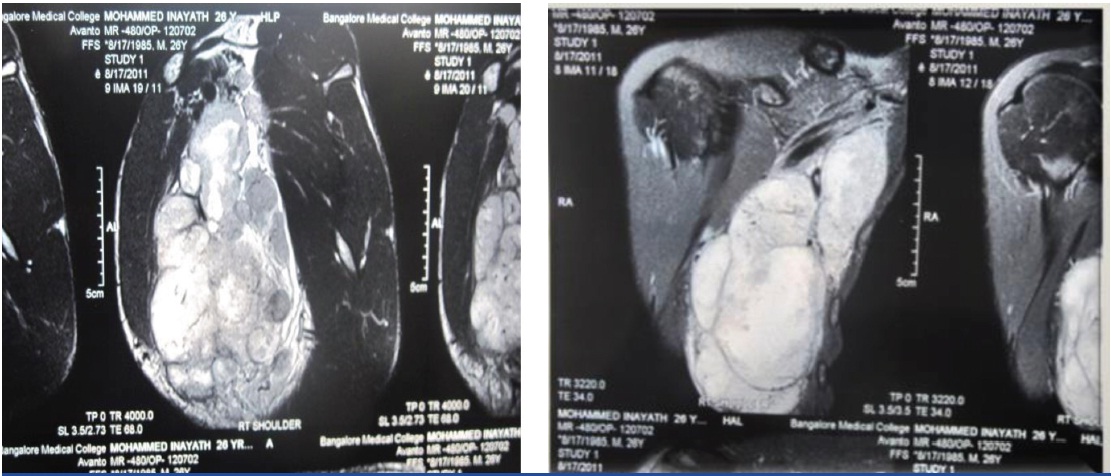 Patient underwent wide local excision of the lesion with level 3 ...