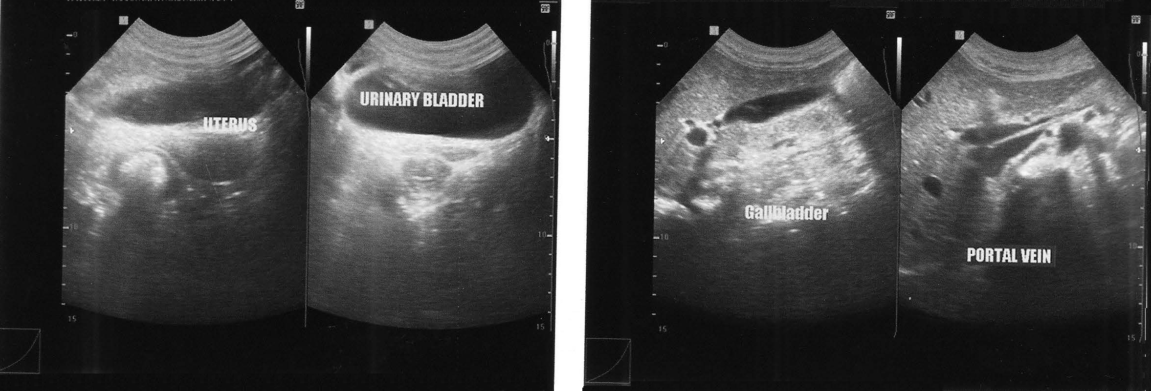 Second ultrasonography showing an in situ IUD - Lippes Loop
