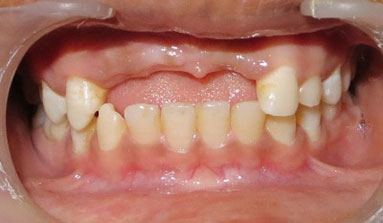 Intraoral photograph showing missing 11, 12 and 21