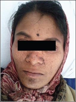 Multiple adenoma sebaceum on face