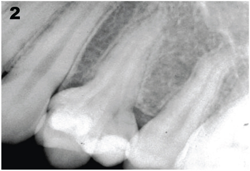 Preoperative radiograph shows the presence of separate roots at cement ...