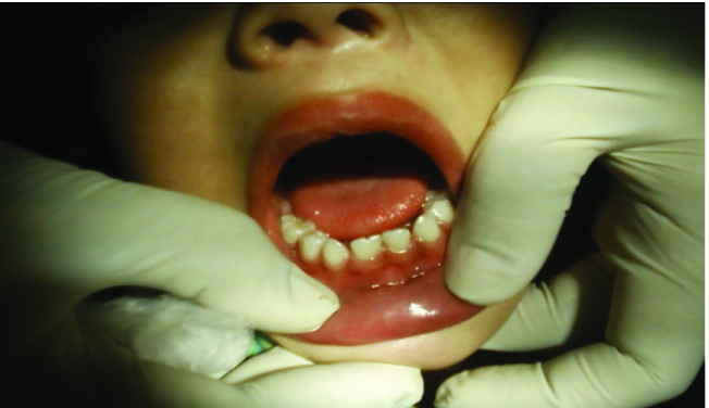 Intraoral view of fused bilateral mandibular central and lateral incisors