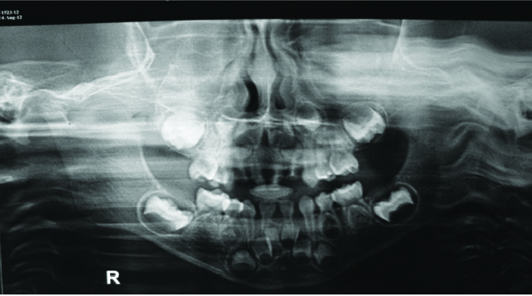OPG showing bilaterally fused mandibular incisors and presence of ...