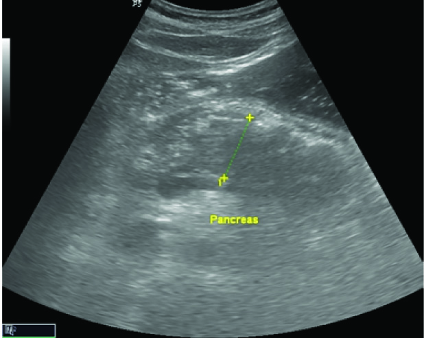 Ultrasonograhy shows features suggestive of acute pancreatitis. The ...