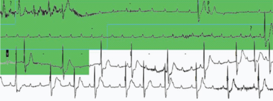 Image of an ECG which revealed an episode of complete heart block (CHB ...