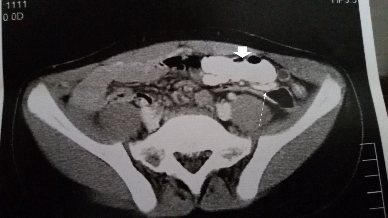 CT imaging showing appendix and cecum in the left abdomen (arrow and ...