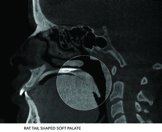 S-shaped soft palate.