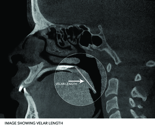 Image showing velar width.