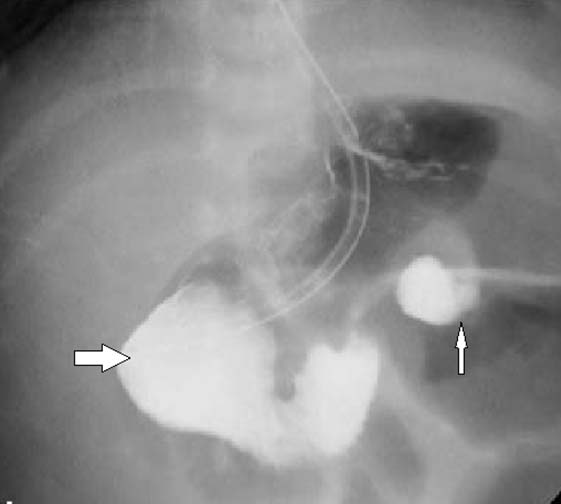 An Upper Gastrointestinal Barium Swallow showing dilated duodenum (bold ...