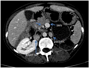 Coronal CECT image: Most of small bowel loops are on right side and ...