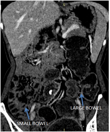 Patient was then referred to Surgery department for further management.