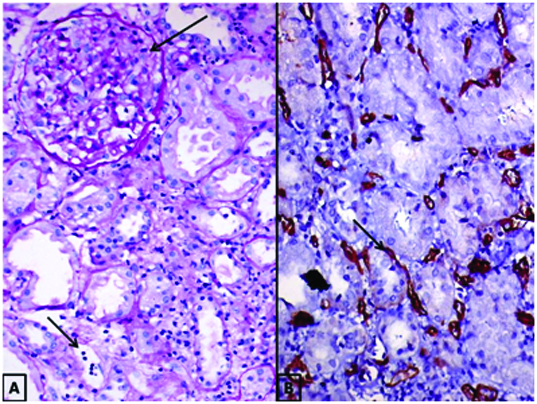 (A) AMR with moderate transplant glomerulitis (long arrow) and moderate ...
