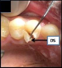 Fractured Cusp Molar