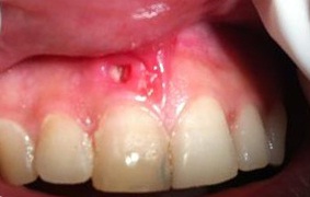 Pre-operative clinical picture showing fenestration with respect to ...