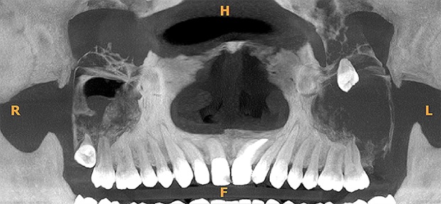 Right maxillary sinus revealed dome shaped expanded hyper dense area ...