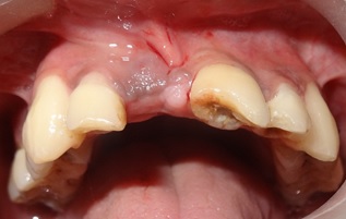 Exposure of knife edge ridge.