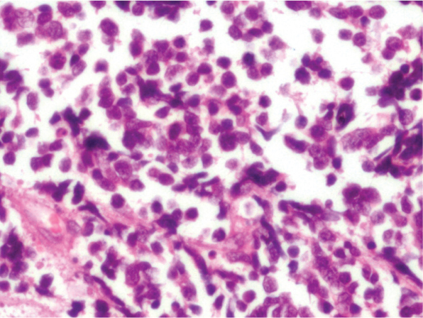 Small malignant cells with hyperchromatic nuclei and scanty cytoplasm ...