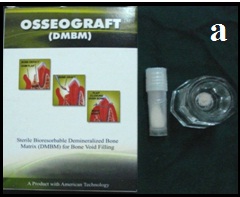Demineralized bone matrix bone graft.