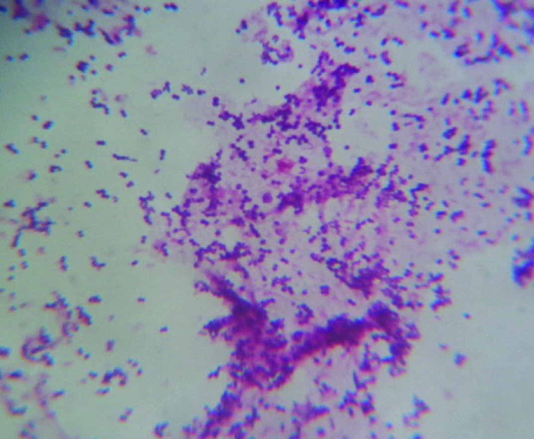Gram positive cocci in clusters along with polymorphonuclear cells in ...