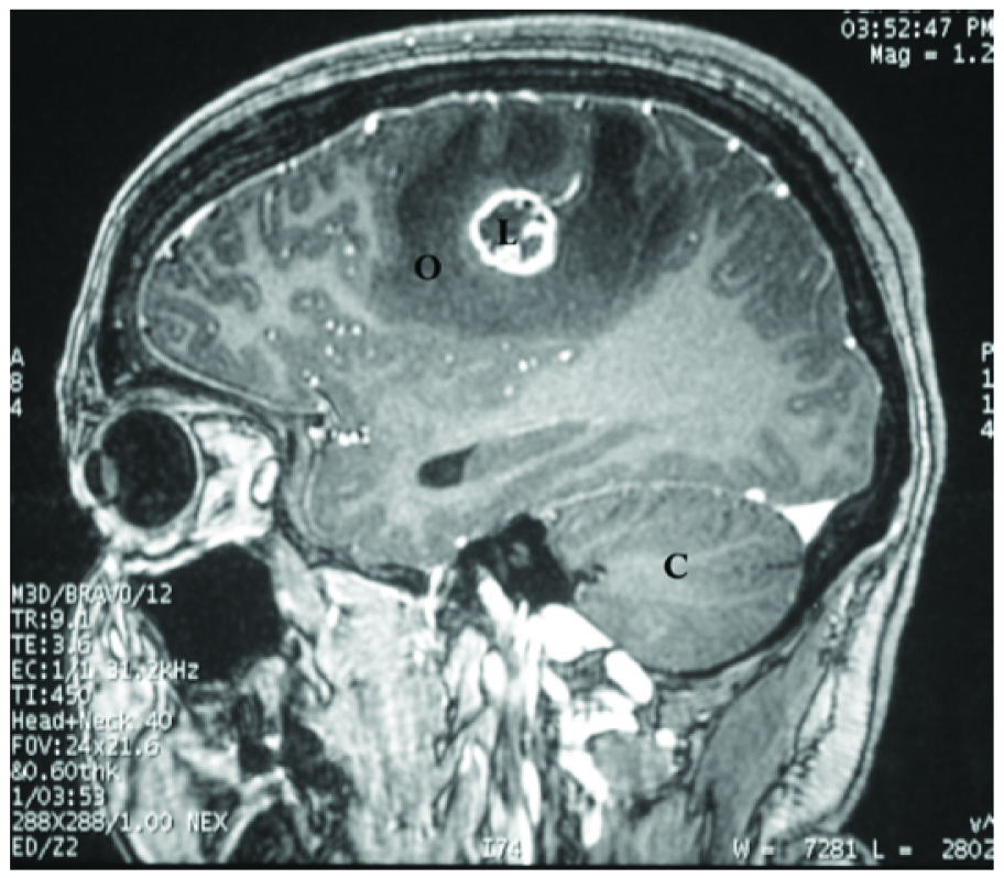 An MRI film of the head (sagittal view) showing metastatic lesion in ...