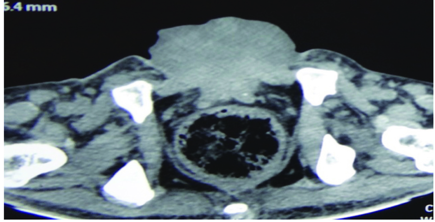 Patient eventually underwent radical cystectomy, lymph node excision ...
