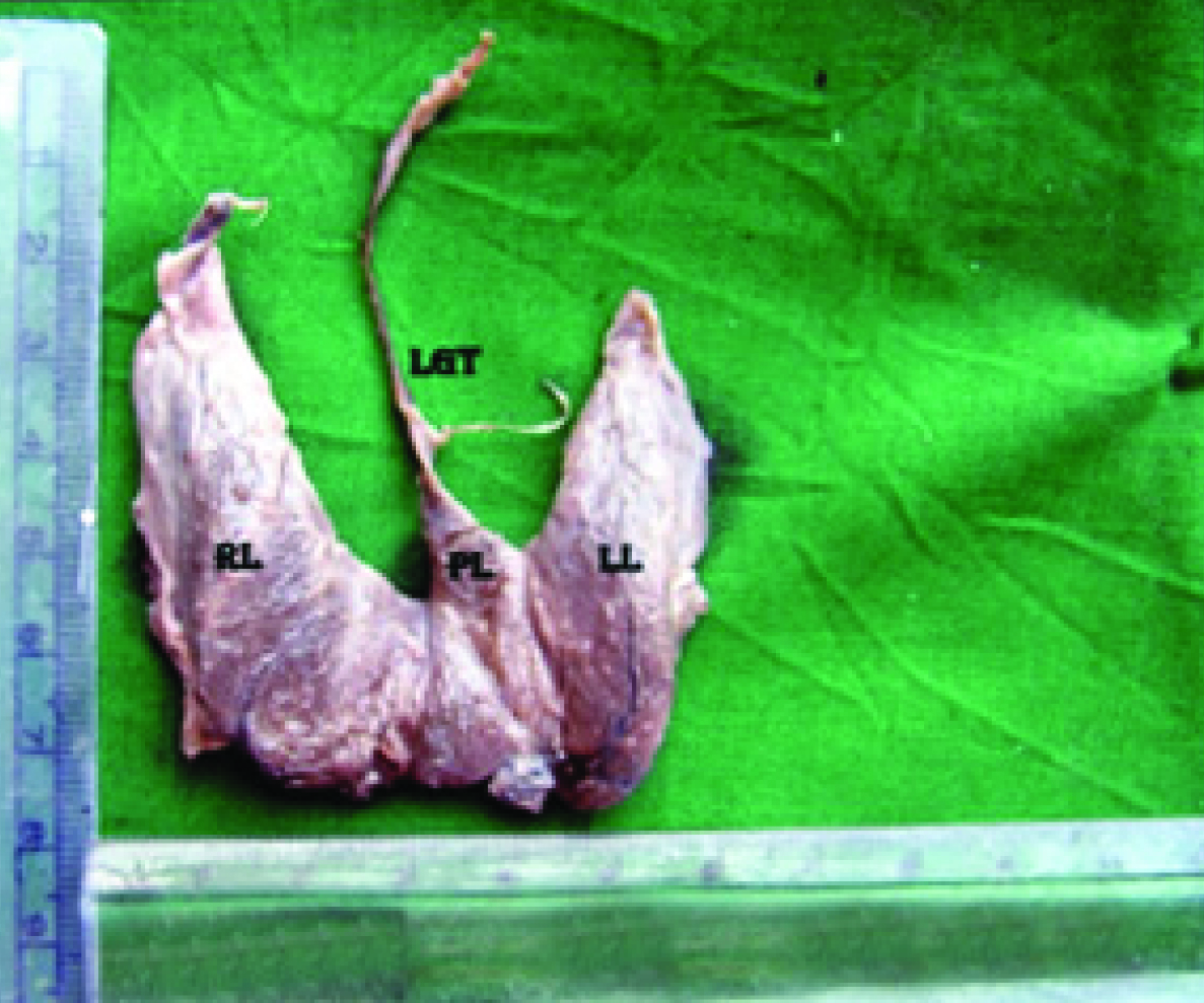 Pyramidal lobe with levator glandulae thyroideae arising from the ...