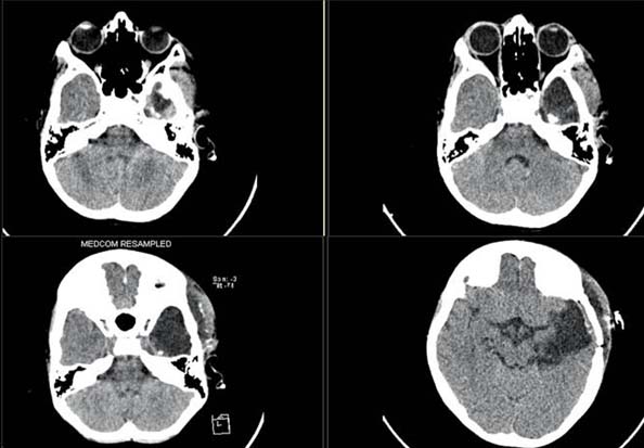 Plain CT brain image showing temporal craniotomy defect with operative ...