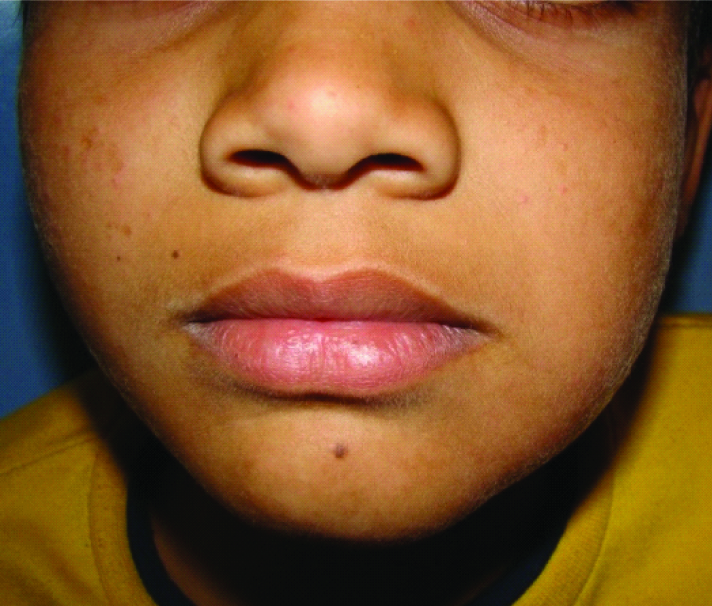 Extra-oral photograph showing the swelling in the left lower part of ...