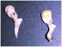 Malleus with variations in the free ends of manubrium – showing ...