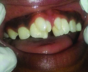 Talon cusp on teeth #11, 21 (incisal view) of case 1- daughter.