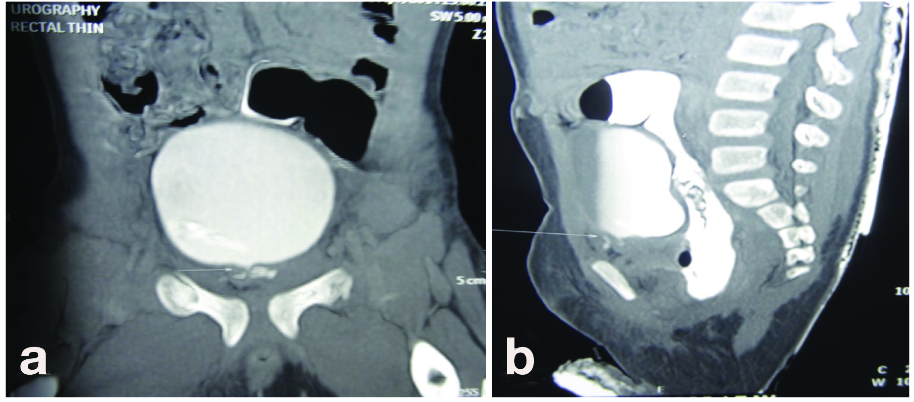 CT scan images of patient-3 showing contrast extravasation at bladder ...