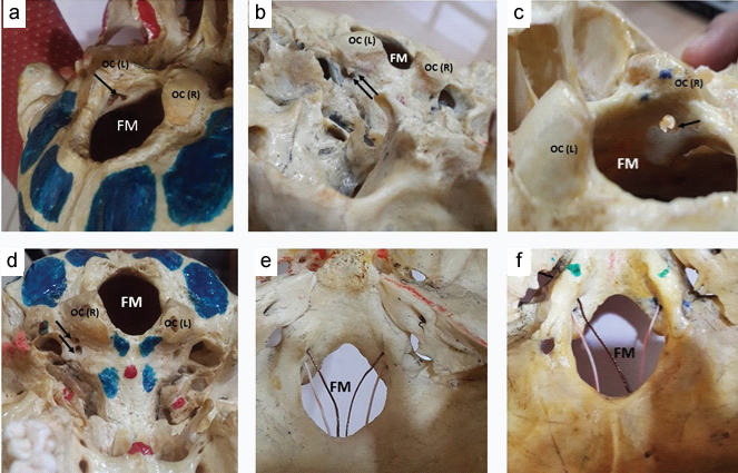 Condylar Canal Occipital Bone