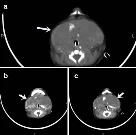 CECT axial section of the neck shows a large multicystic lesion with ...