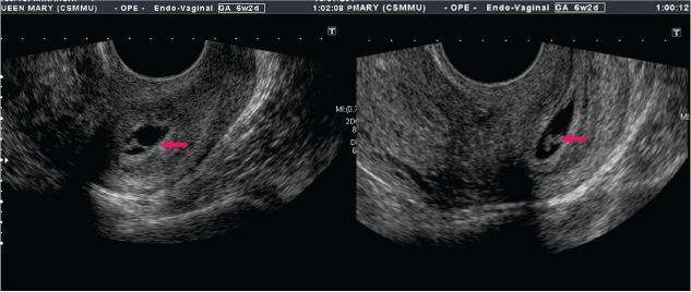 USG showing cervix with closed internal os and a gestational sac with ...