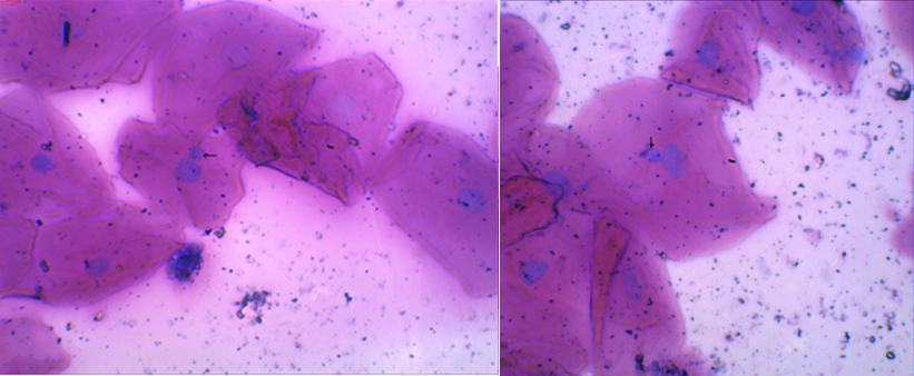 Micronucleus- The arrow shows MN (Micronucleus – present inside the ...