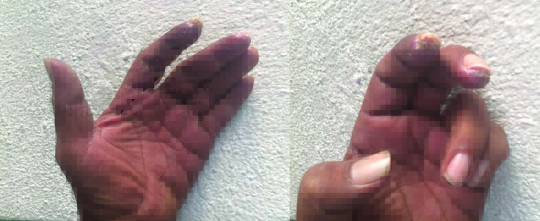 Black patchy lesion – left middle finger.