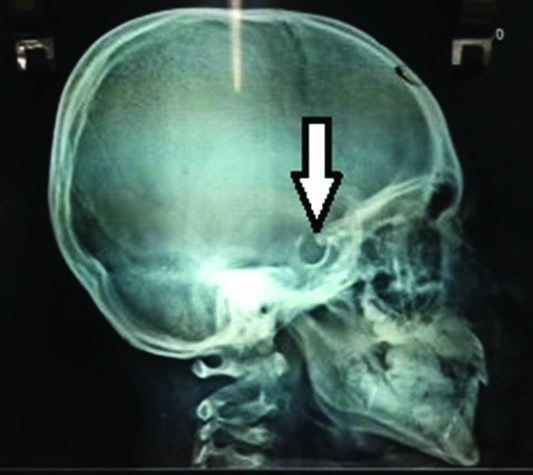 Increased depth of sella turcica in X-ray skull lateral view (white arrow).