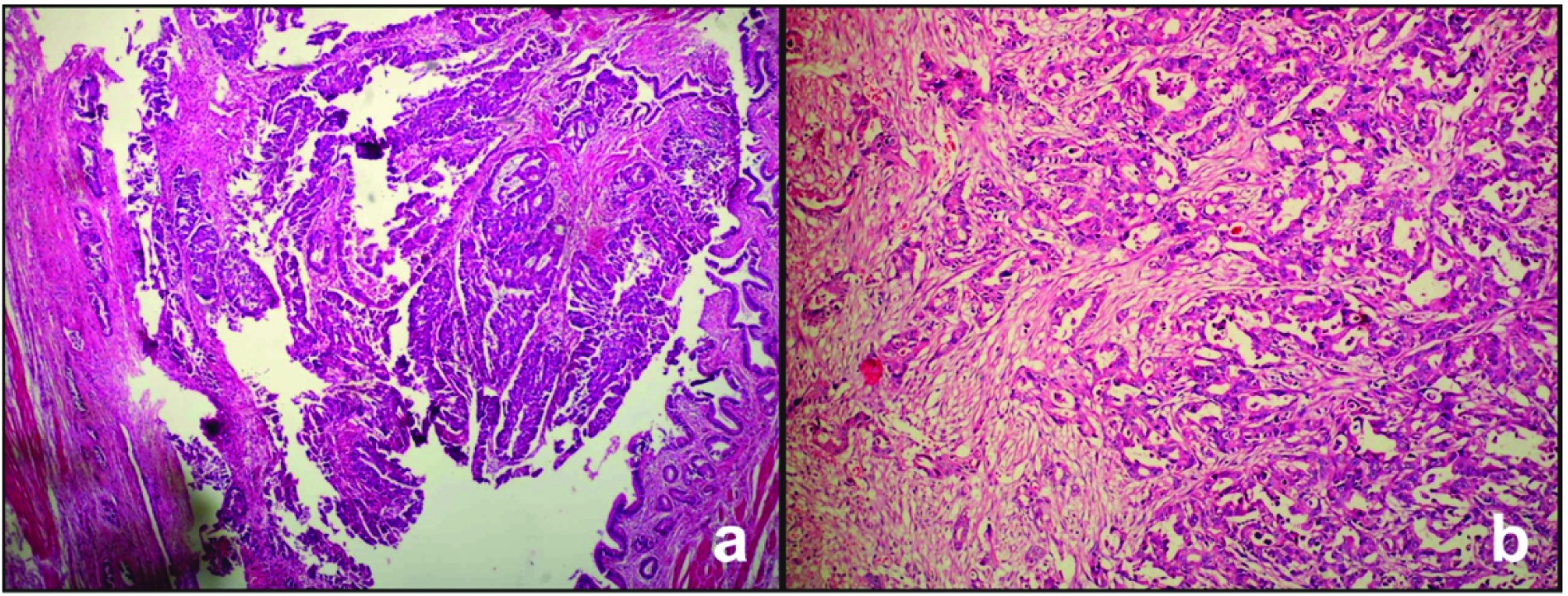 Ampulla Of Vater Histology
