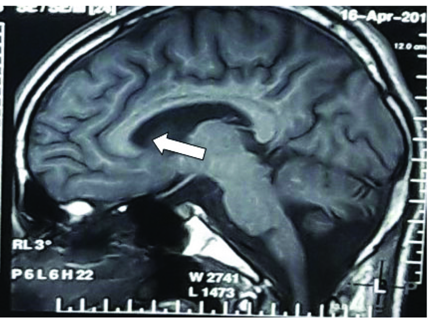 MRI image showing enlarged ventricles (arrow).