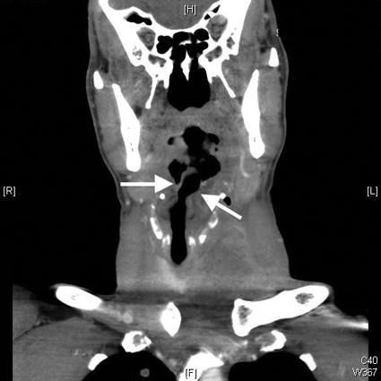 Tracheal Deviation Neck